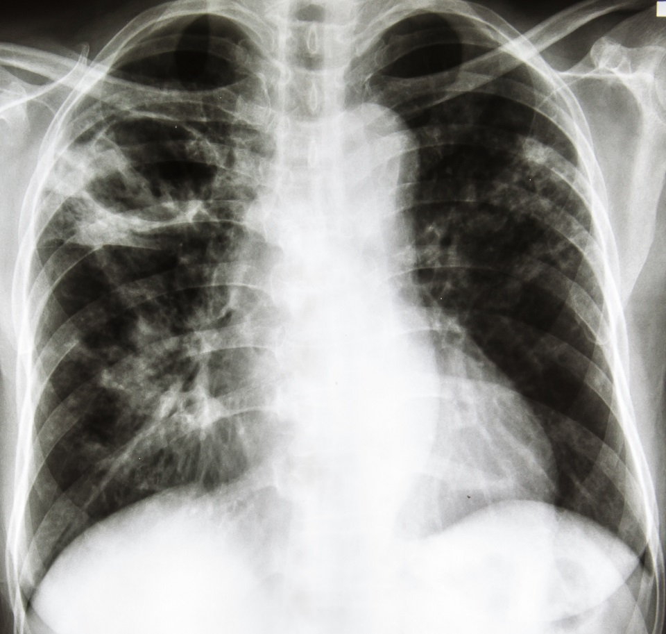 Investigation into CT Scan Radiation Overdose